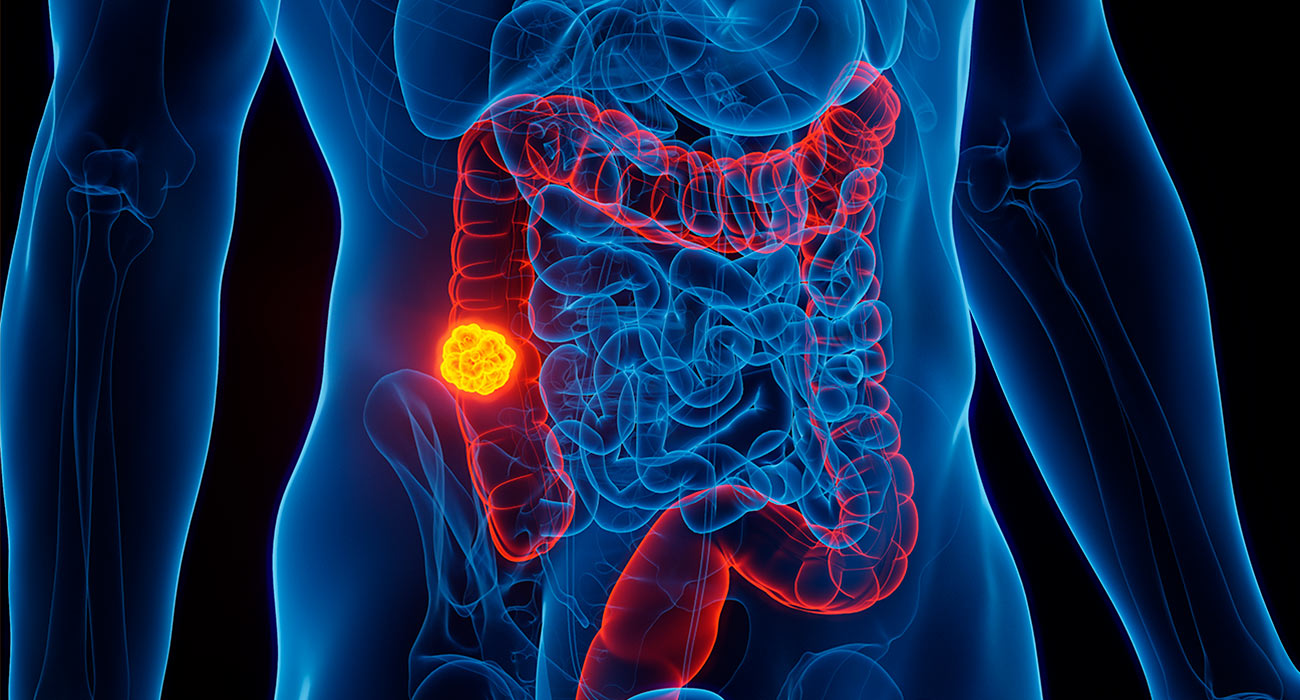Cáncer de colon el más habitual y de mayor prevalencia en España